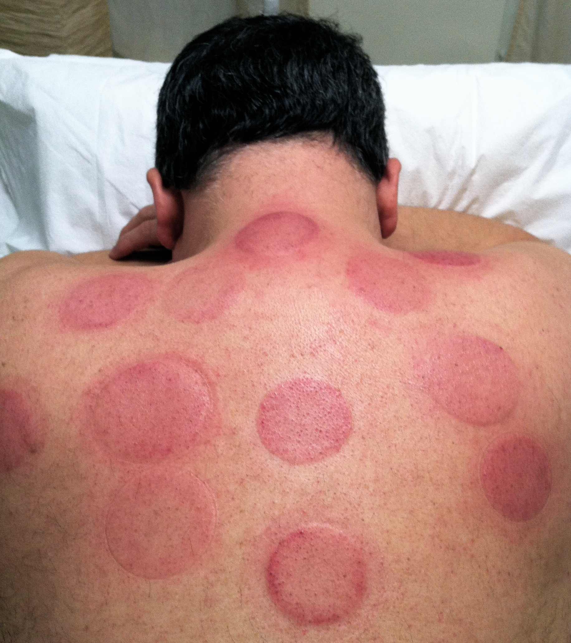 Cupping Therapy Explained by Jersey Shore Acupuncturist Rob Vena « Rob ...